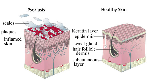 Is psoriasis a chronic disease? « V-PSor psoriasis cream