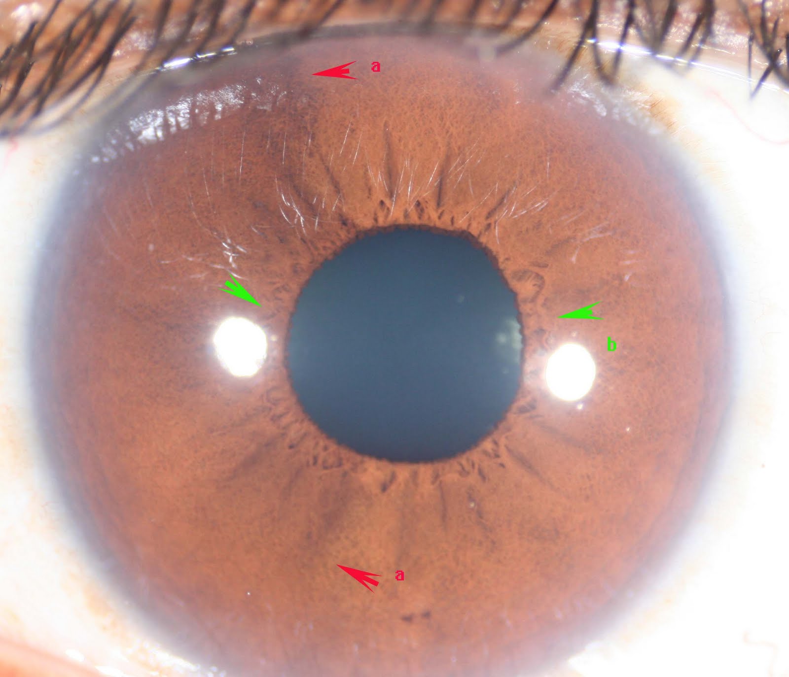 Modern & Multidimensional Iridology: Sectoral Dark Brown & Constricted ...