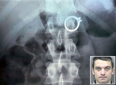 Art-Sci: Gulp! Swallowed Objects Revealed by X Rays