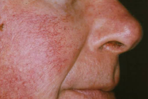 Siempre perfecta!!: Rojeces?????