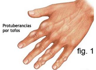 Blogão de Fisio: ARTRITE GOTOSA