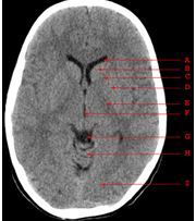 Dr Herry Setya Yudha Utama SpB. FInaCS. MHKes. ICS: Seri Bedah Saraf ...