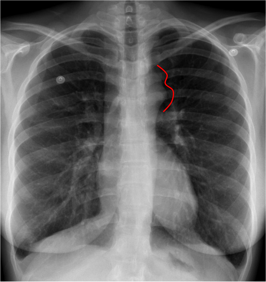 Medical Addicts: Chest X-ray: Coarctation of Aorta: Figure 3 sign