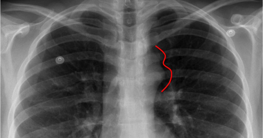 Medical Addicts: Chest X-ray: Coarctation of Aorta: Figure 3 sign