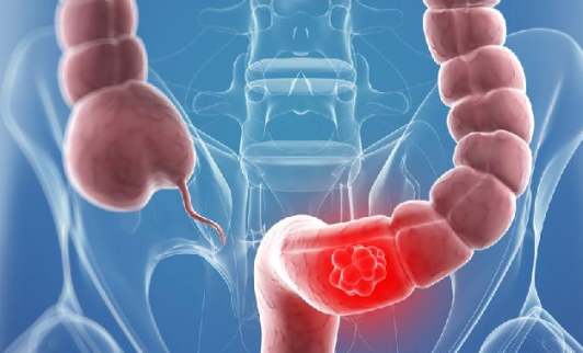 Stage 4 Colon Cancer Life Expectancy stage-4-colon-cancer-life-expectancy