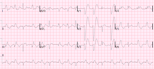Dr. Smith's ECG Blog: Crushing Chest pain, but the ECG is not obvious ...