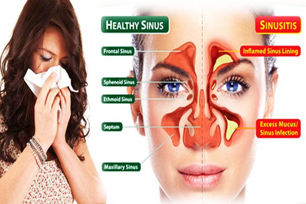 Apa Itu Operasi Sinus - Perumperindo.co.id