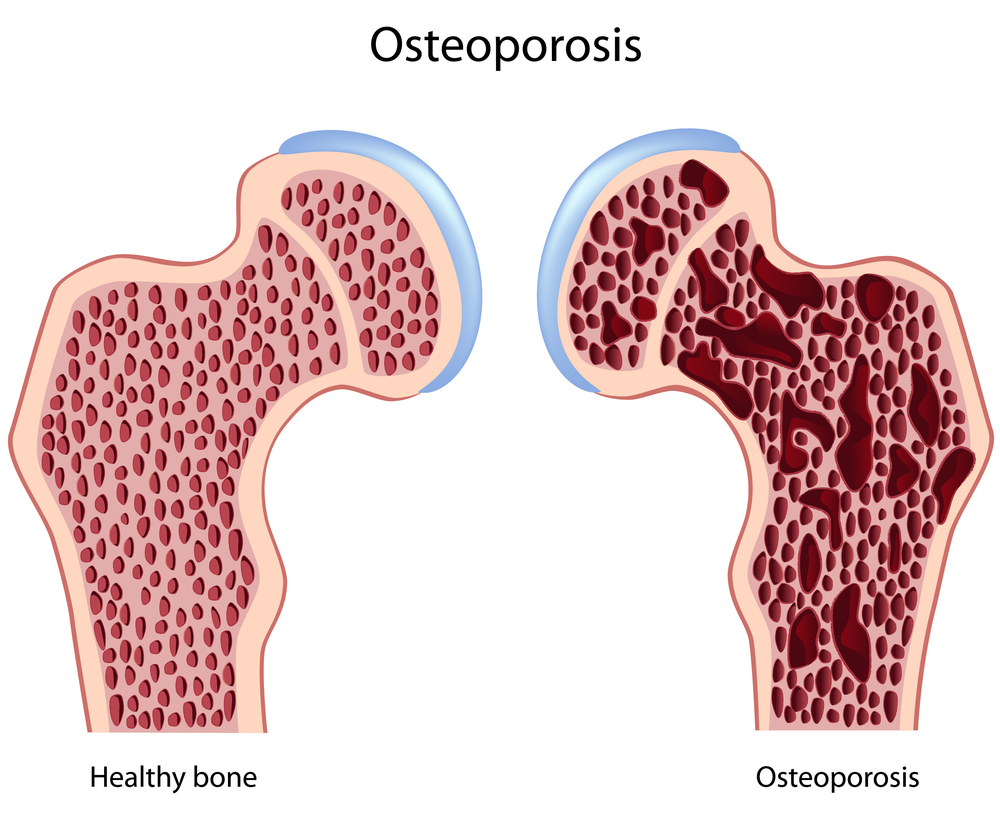 Todo Acerca de la Osteoporosis | BIENVENIDO A DXN PANAMA