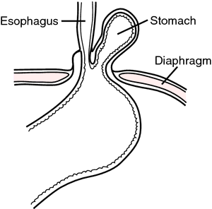 Hiatus Hernia: Hiatus Hernia - What you must Recognize