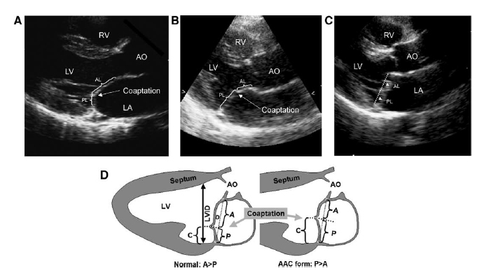 ECHOVAR: ECO DEL DIA: Prolapso mitral revisado