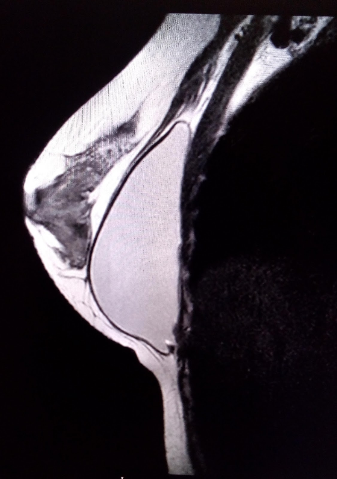 Breast Implant MRI : Teaching Points - Sumer's Radiology Blog