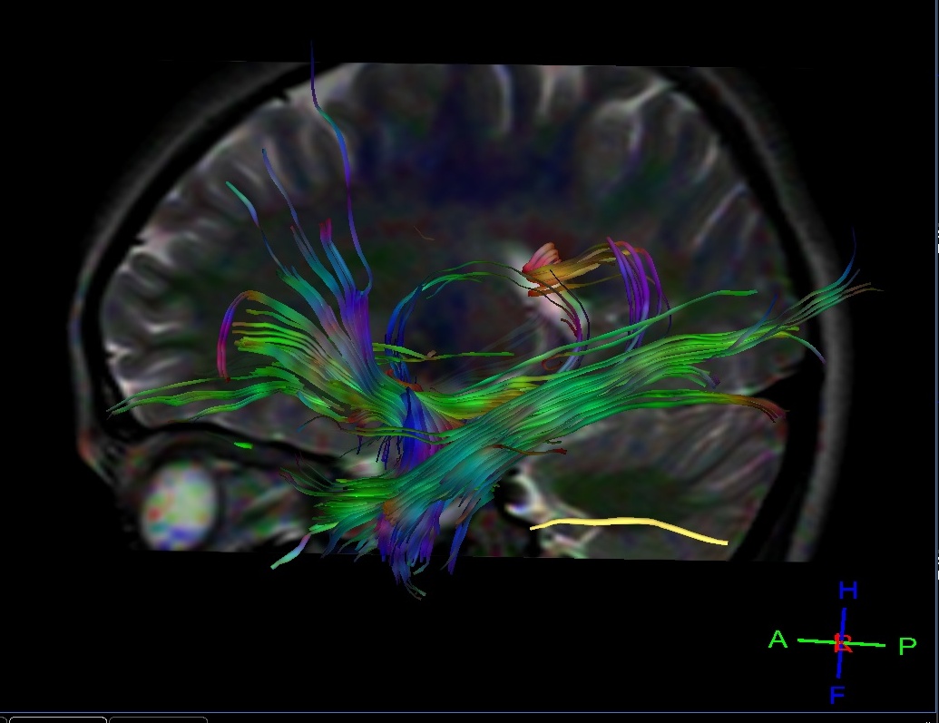 Leber's Optic Atrophy-DTI - Sumer's Radiology Blog