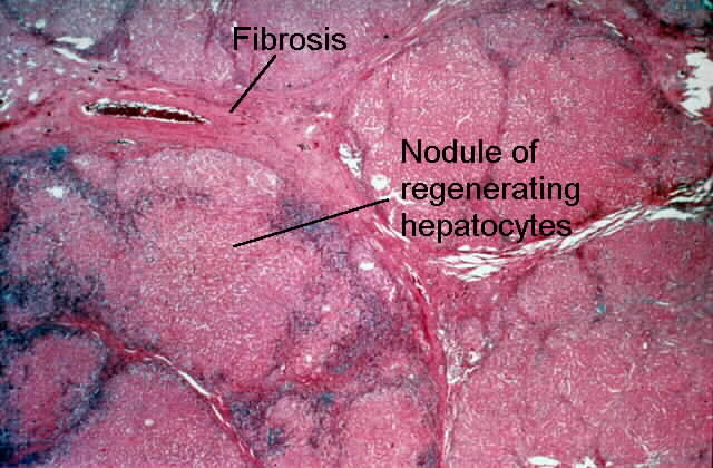 Be Positive Nurse: ASKEP Sirosis Hepatis