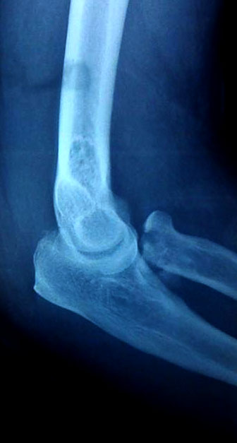 O R T O C R I T I C A: Fractura de cabeza radial asociado a ...