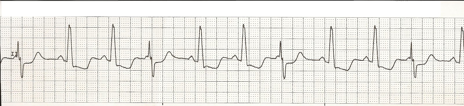 EKG Rhythm Strip Quiz 19