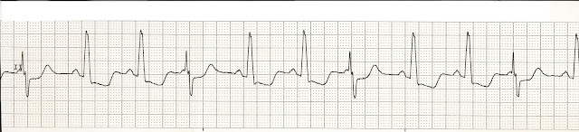 EKG Rhythm Strip Quiz 19