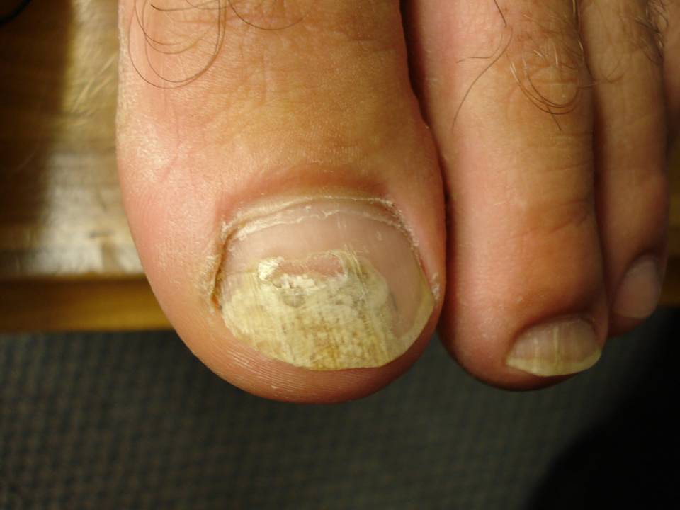 Consultations in Dermatology: The Crumbly Nail - Onychomycosis