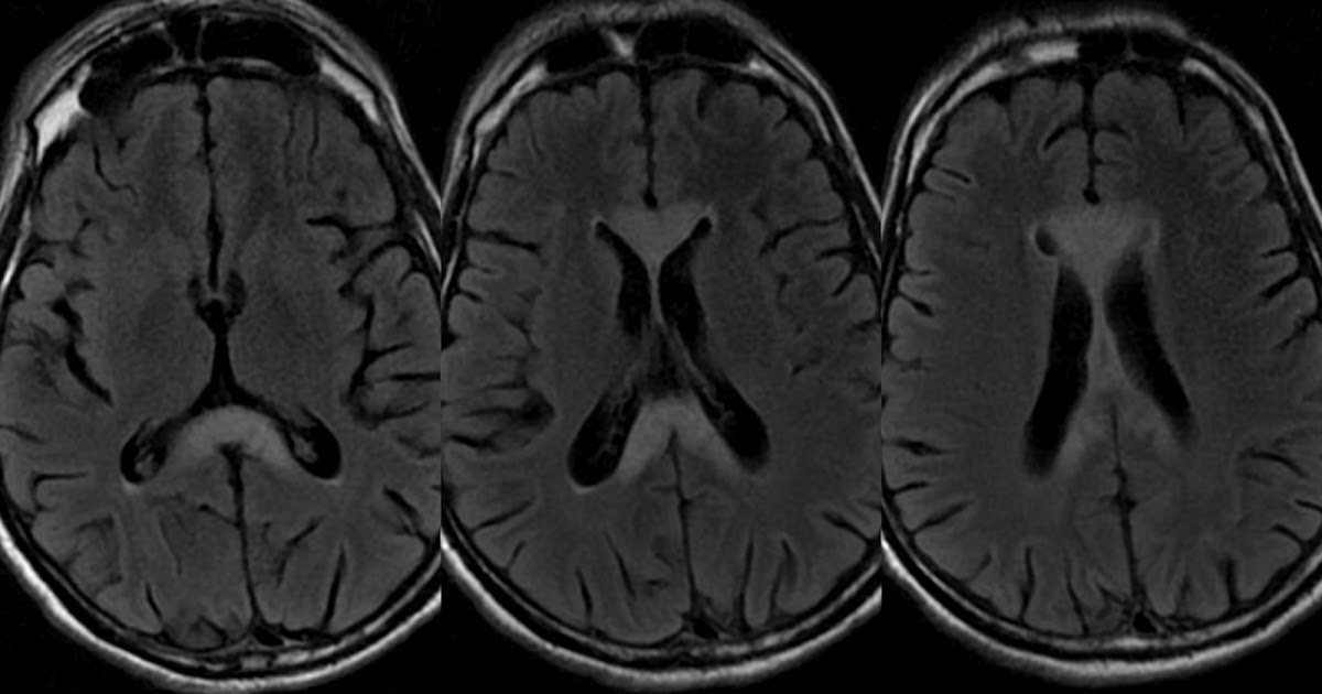 Neuroradiology Cases: Marchiafava Bignami Disease MRI