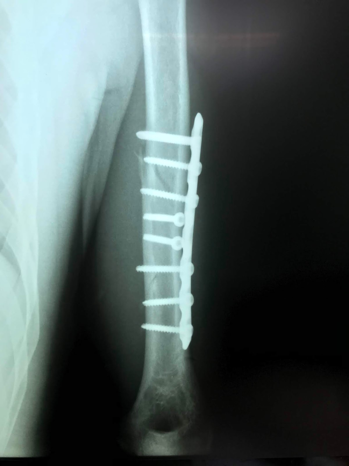 Ortopedia para internos HCG: Fractura de diáfisis distal de húmero