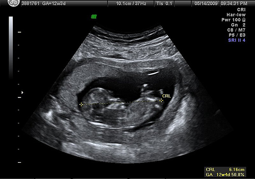 Usg4dimensitangerang: PENJELASAN HASIL USG TRIMESTER 1