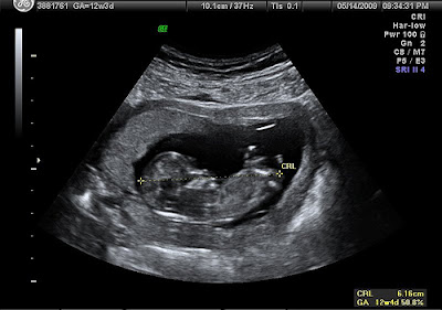 Usg4dimensitangerang: PENJELASAN HASIL USG TRIMESTER 1