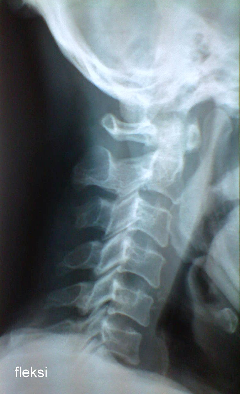 PEMERIKSAAN CERVICAL DINAMIK