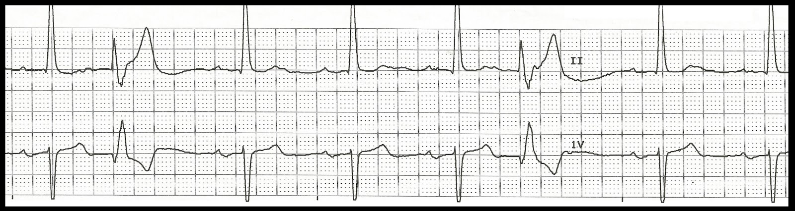 Practice EKG Rhythm Strips 184