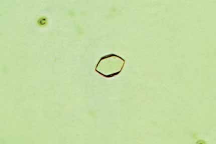 [Haematology] Microscopic Examination of Urinary Sediment - Crystals ...