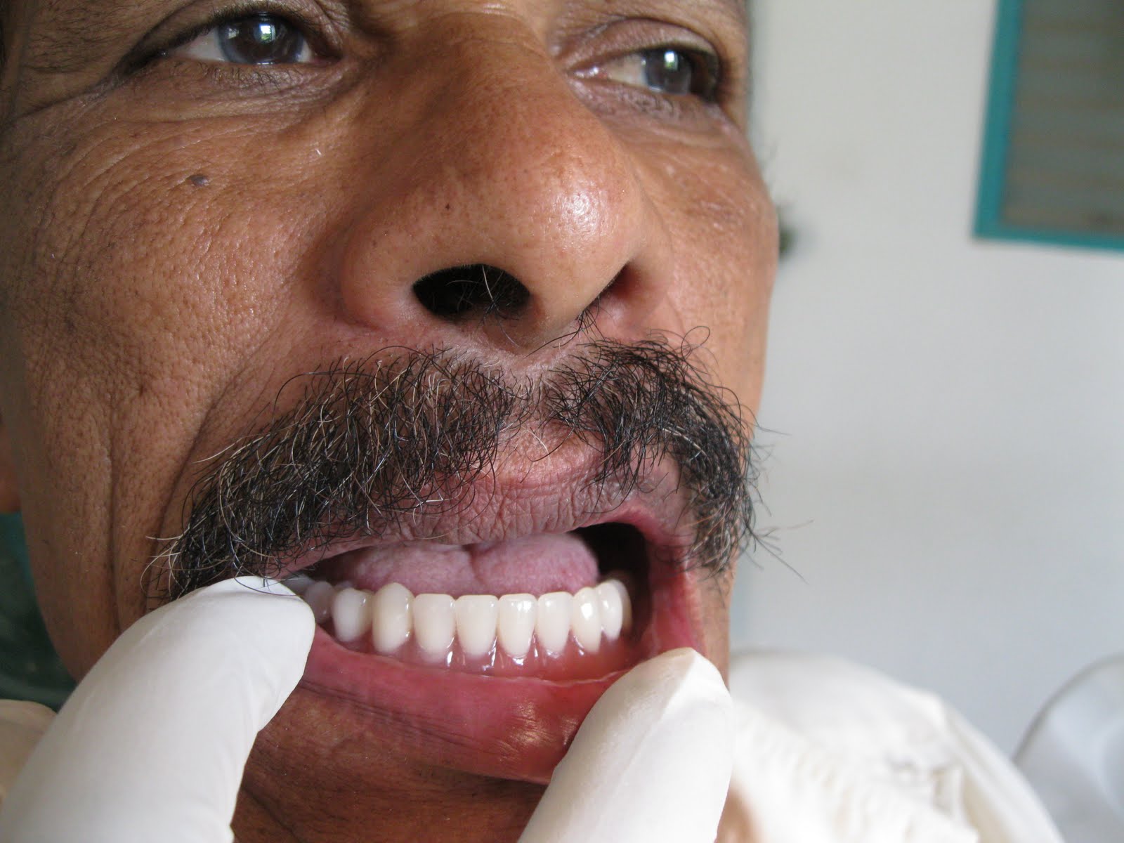 DENTO CARE DENTAL CLINICS: COMPLETE DENTURES-IN MELIODENT BY KULZER