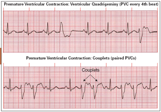 Ventrikel Ekstra sistole ( VES ) - MUZARRO