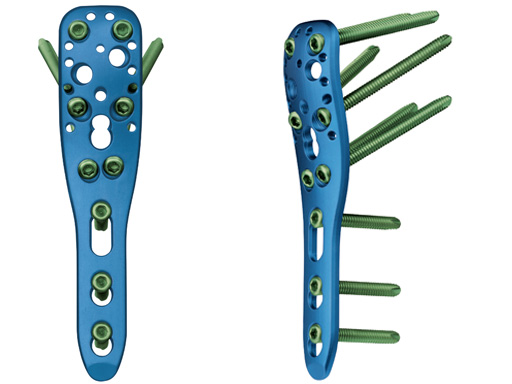 Osteosintesis: Placa Philos