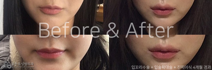 Goldenview Plastic surgery: lip lift - koreacosmetic,plastic surgery
