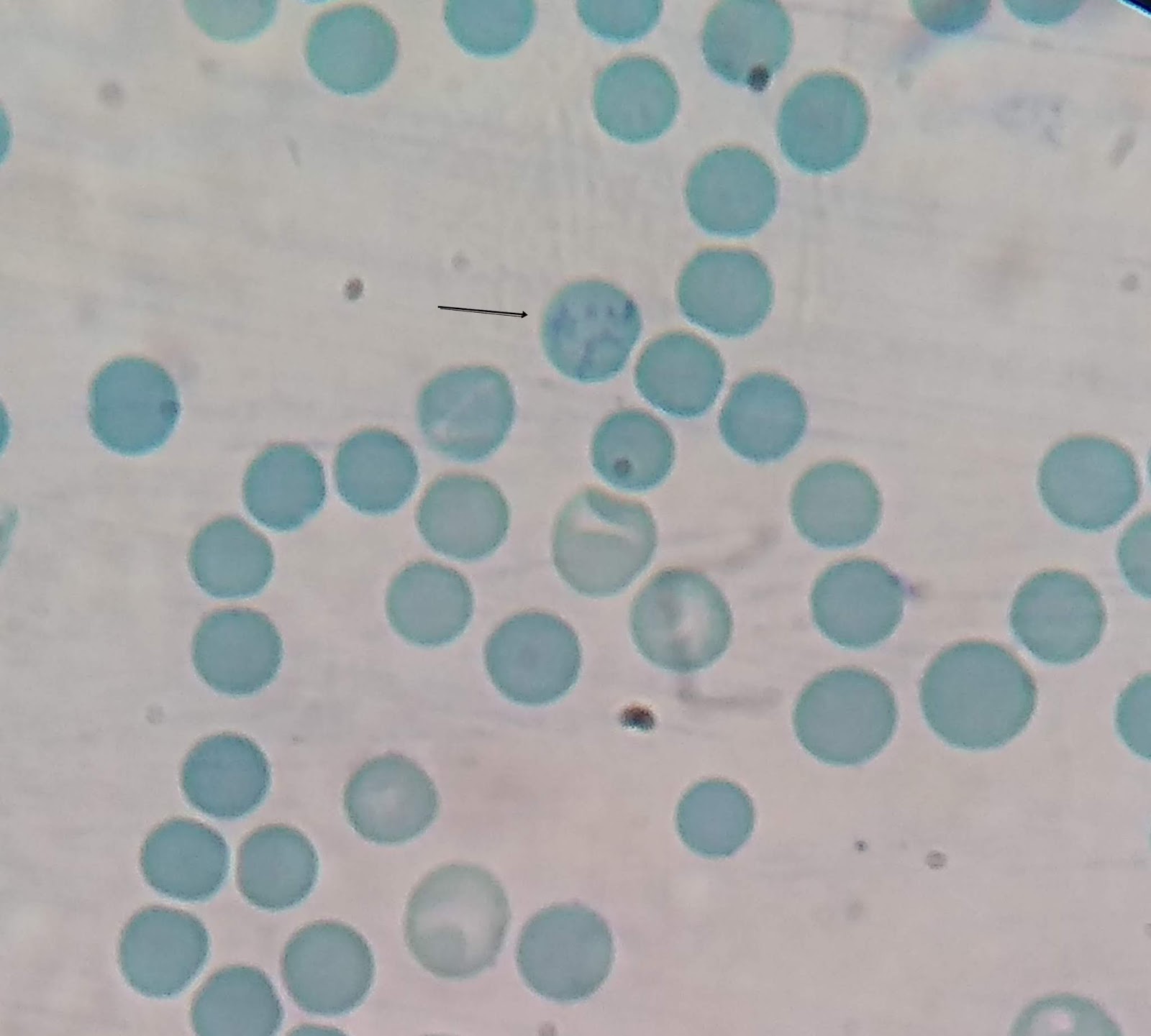 Contagem de Reticulócitos