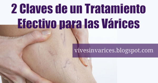 2 Claves para el Tratamiento de las Várices que Debes Tomar en Cuenta ...