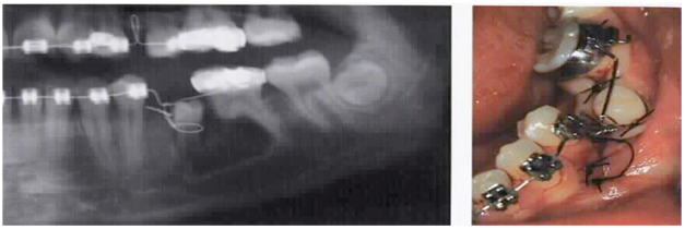 Dentistry and Medicine: Surgical management of Unerupted and Impacted teeth
