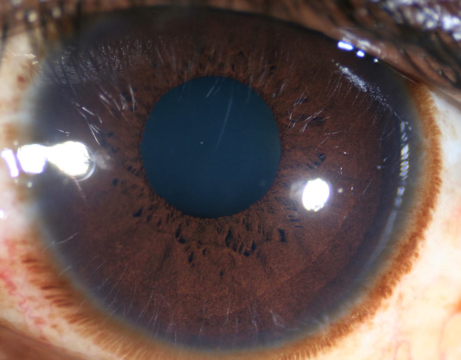 Modern & Multidimensional Iridology: Multiple Crypts Formation at ...