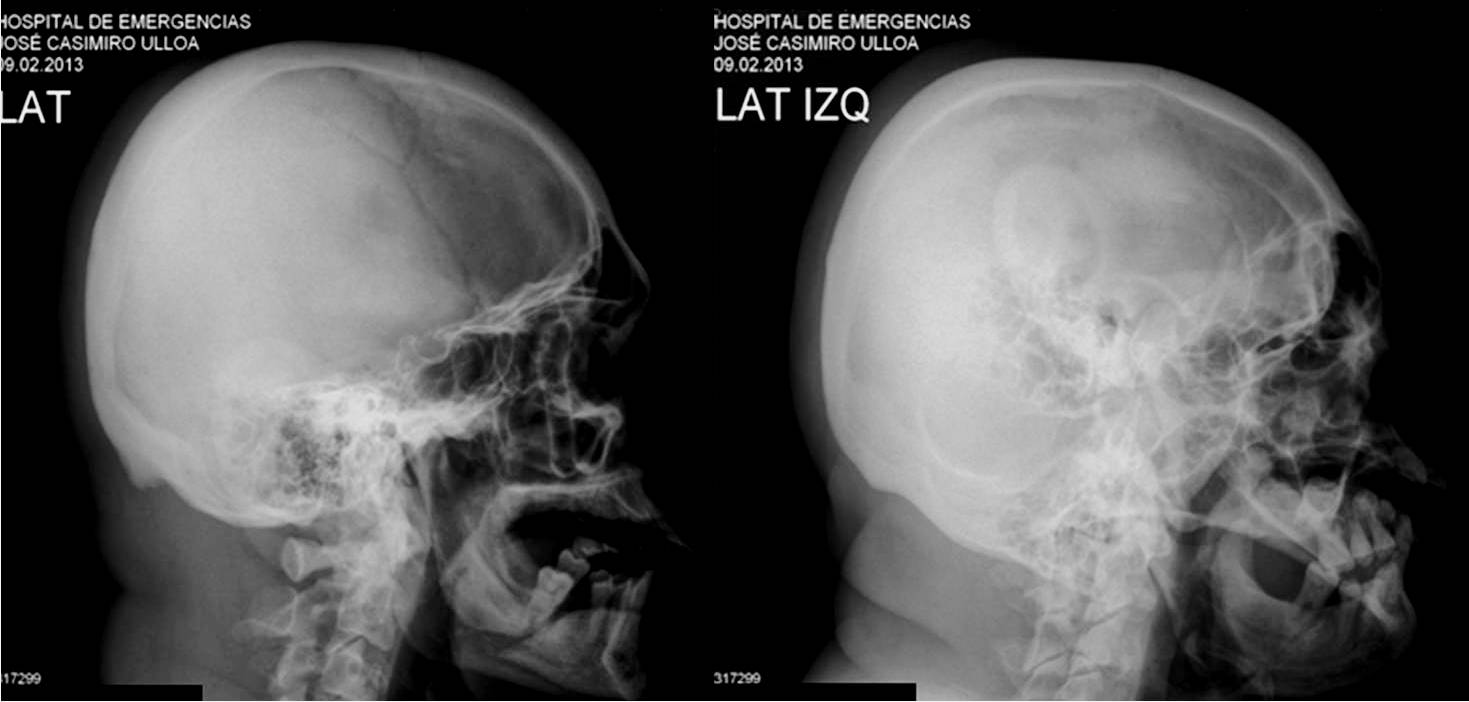 CASIMIRO RADIACTIVO: PASEANDO POR RAYOS X