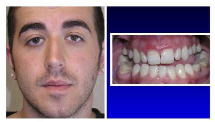 Facial Development Newsletter: AN ALTERNATIVE TREATMENT TO LEFORTE ...