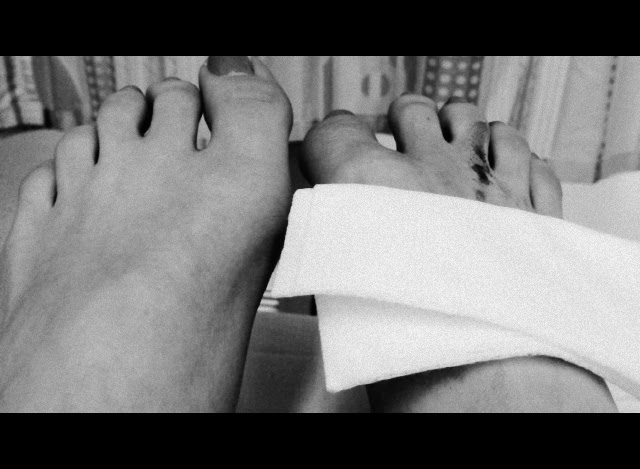 The EHL Tendon Chronicles: Injury, Surgery & Recovery: The Incident