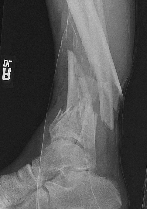Case of the Month: Fracture cases at Harborview Medical Center ...