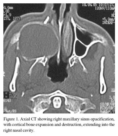 Radiologist For Ever: Paranasal sinuses rule 3 :Causes of sinus ...