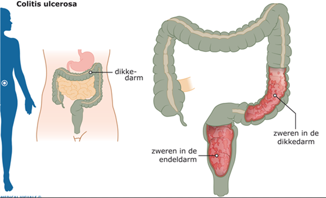 DE ANATOMIE EN PATHOLOGIE VAN DE DARM: INFLAMMATOIRE DARMZIEKTEN