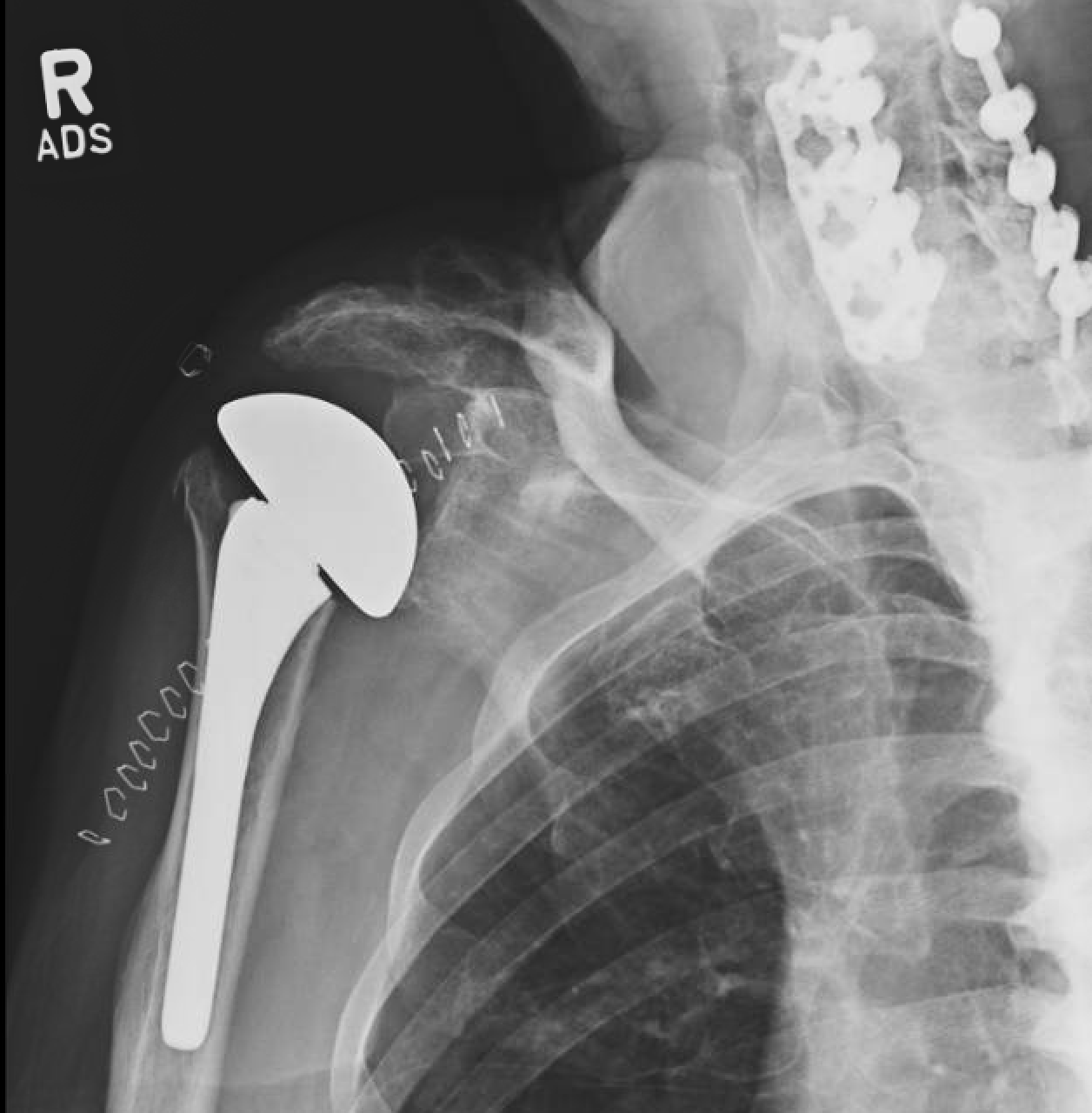 Shoulder and Elbow Surgery: Dislocation of reverse shoulder replacement ...