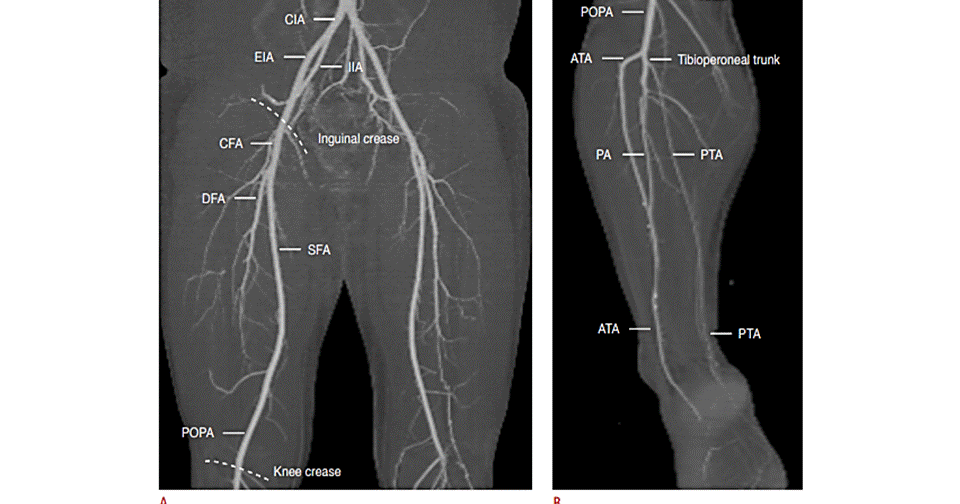 BÀI SOẠN VỀ SIÊU ÂM CHẨN ĐOÁN: Doppler Ultrasonography of the Lower ...