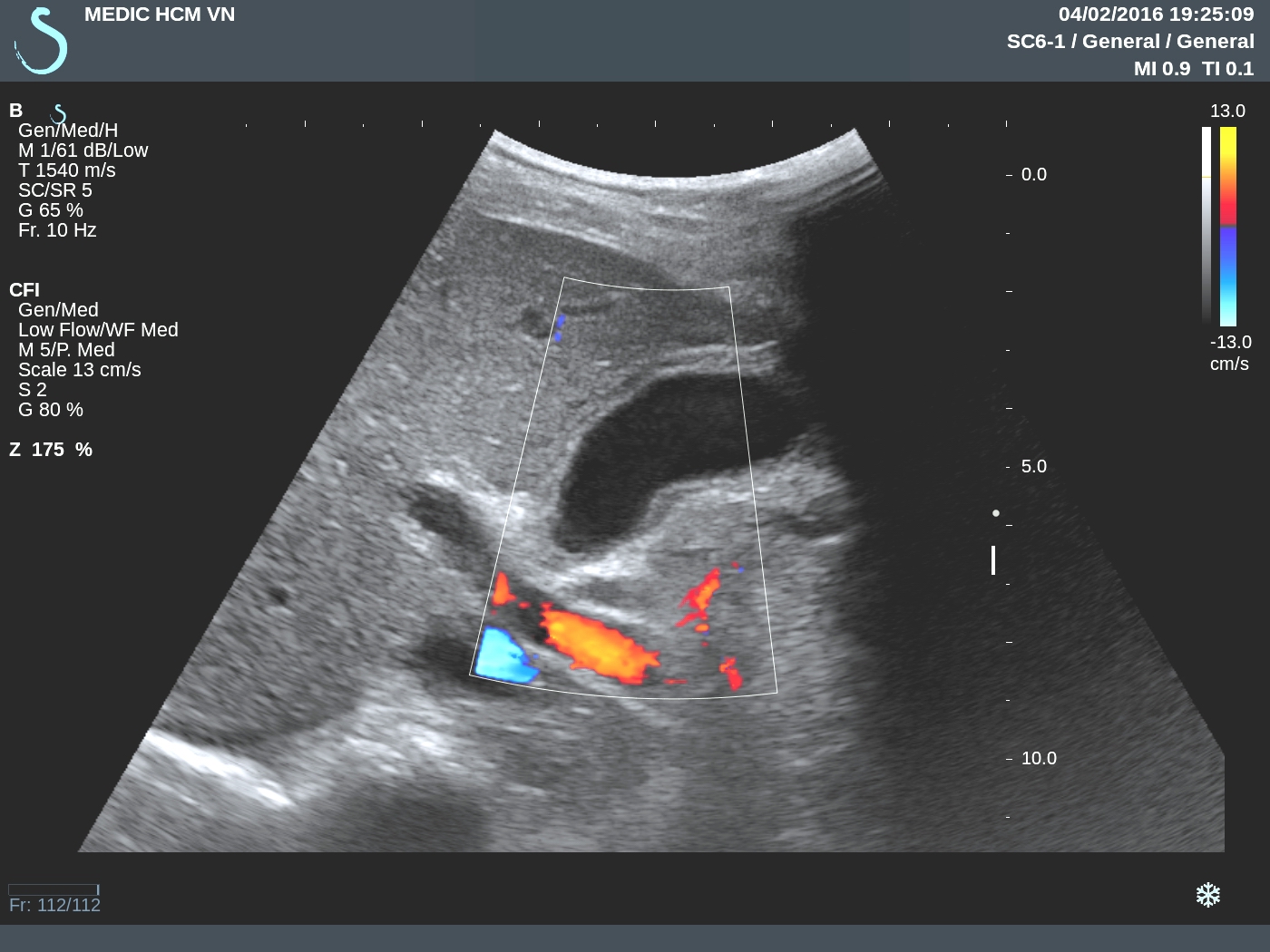 VIETNAMESE MEDIC ULTRASOUND: CASE 363: MURPHY'S SIGN POSITIVE, Dr PHAN ...
