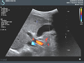 VIETNAMESE MEDIC ULTRASOUND: CASE 363: MURPHY'S SIGN POSITIVE, Dr PHAN ...