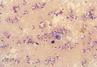 [Haematology] Atlas of Serous Body Fluids | Free Medical Atlas