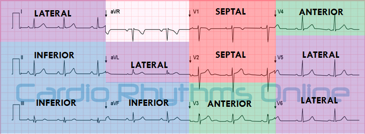 Inferior STEMI my coworker had the other day : r/ems