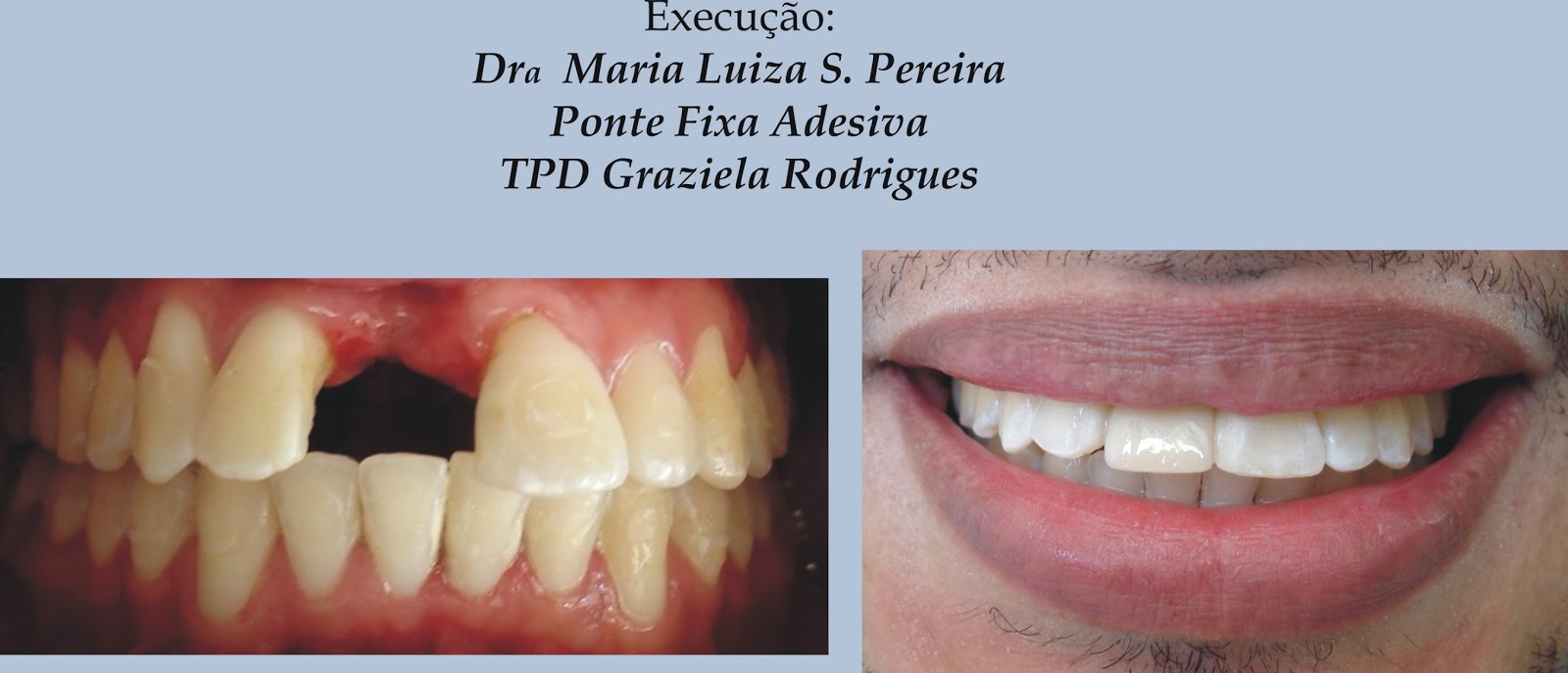 SORRISO! : Ponte Fixa Adesiva