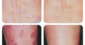 Tipos de Psoriasis | ¿Cuales son los Tipos de Psoriasis?!